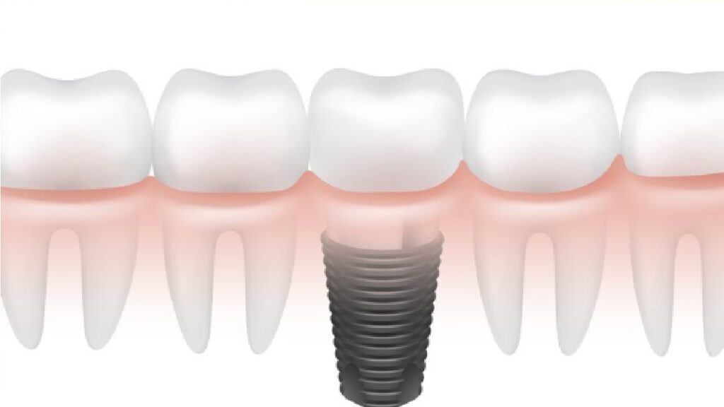How To Perform Upper Denture Implants?